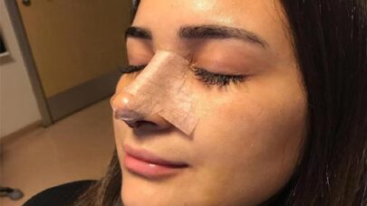 Nose Job Aftercare and Recovery Guide